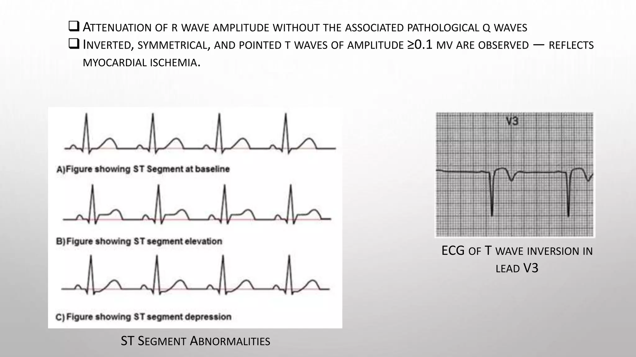 Myocardial infarction: introduction, clinical manifestation ...