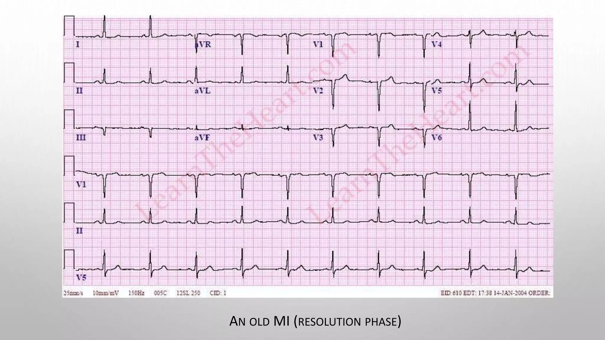 Myocardial infarction: introduction, clinical manifestation ...