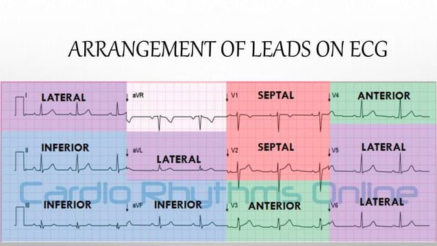 Myocardial infarction: introduction, clinical manifestation ...