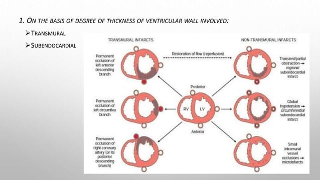 Myocardial infarction: introduction, clinical manifestation ...