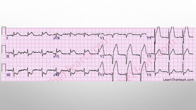 Myocardial infarction: introduction, clinical manifestation ...