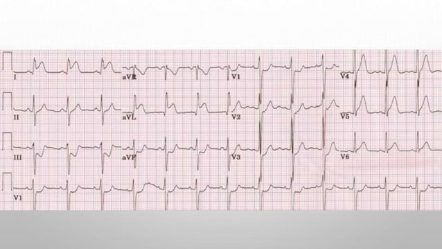 Myocardial infarction: introduction, clinical manifestation ...