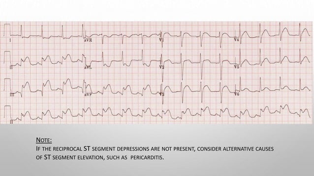 Myocardial infarction: introduction, clinical manifestation ...