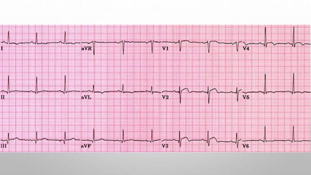 Myocardial infarction: introduction, clinical manifestation ...
