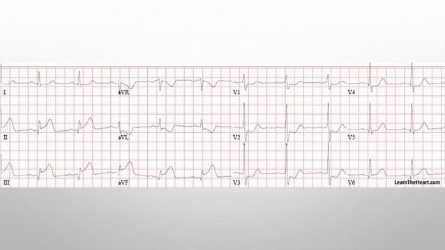 Myocardial infarction: introduction, clinical manifestation ...