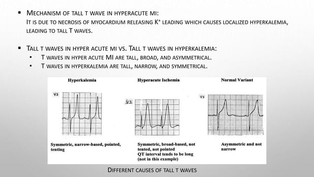 Myocardial infarction: introduction, clinical manifestation ...