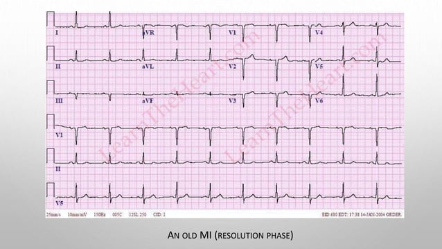 Myocardial infarction: introduction, clinical manifestation ...