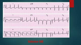 Myocardial infarction (MI) ppt | PPTX