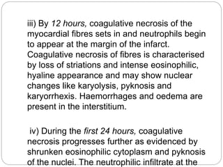 Myocardial infarction | PPTX