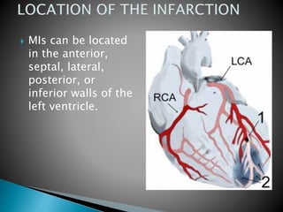 Myocardial infarction | PPTX