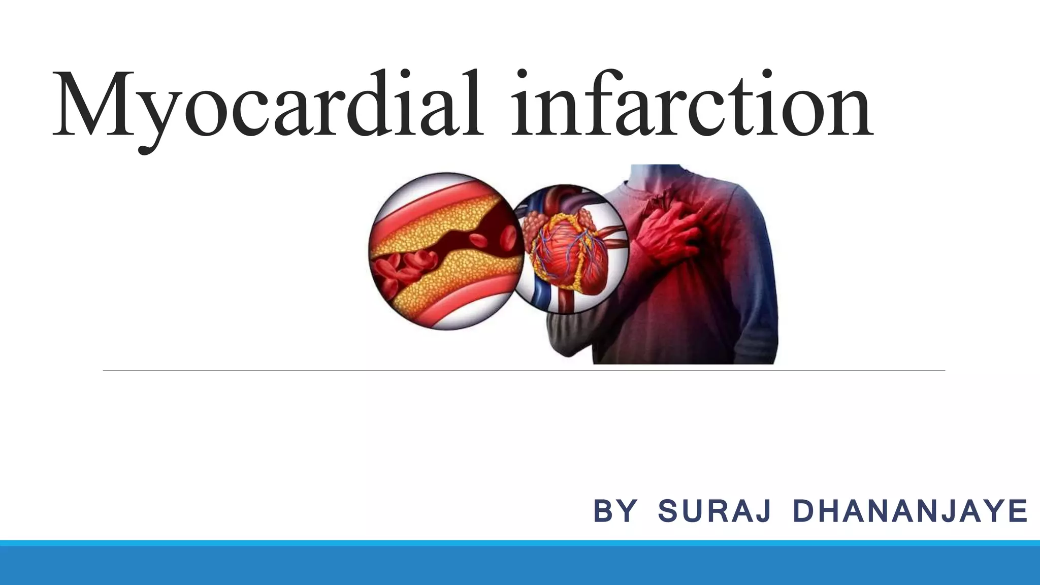 Myocardial infarction | PPTX