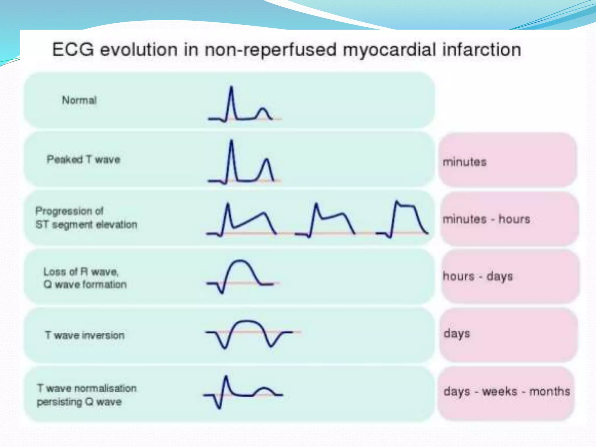 Myocardial infarction | PPTX