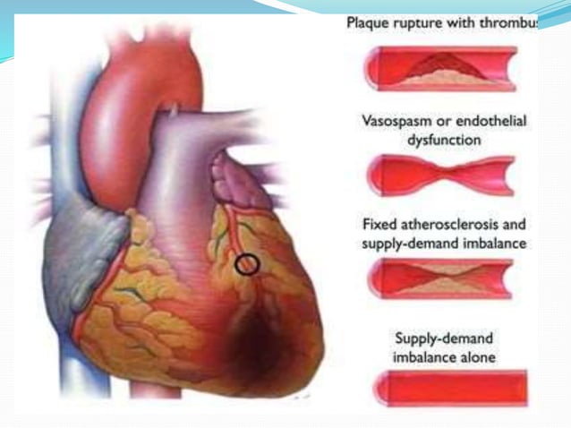 Myocardial infarction | PPT