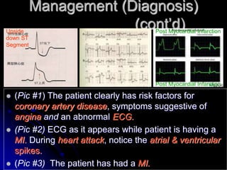 Myocardial Infarction.ppt