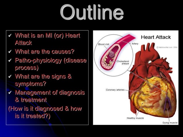 Myocardial Infarction.ppt