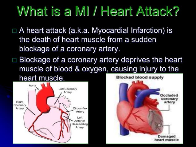 Myocardial Infarction.ppt
