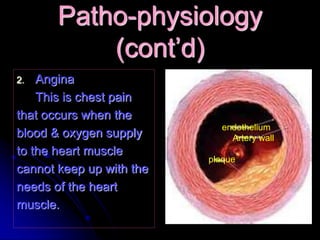 Myocardial Infarction.ppt