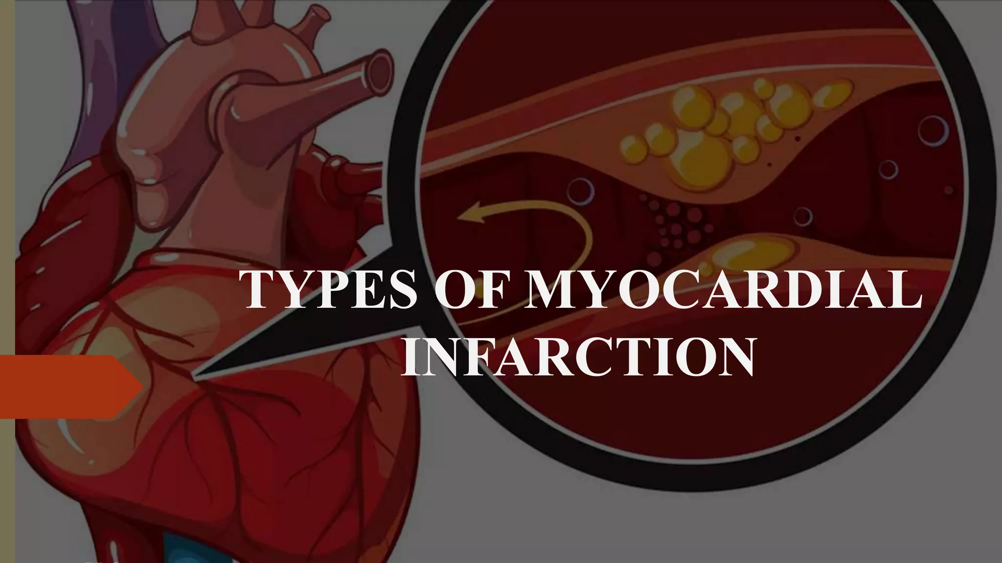 MYOCARDIAL INFARCTION.pptx