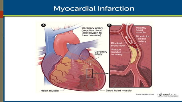MYOCARDIAL INFARCTION.pptx | Heart and Cardiovascular Diseases ...