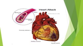Myocardial Infarction.pptx