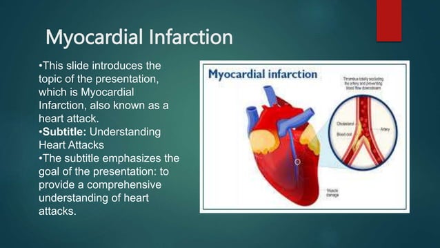 Understanding Myocardial Infarction: Pathophysiology, Diagnosis, and ...
