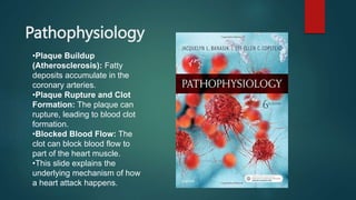 Understanding Myocardial Infarction: Pathophysiology, Diagnosis, and ...