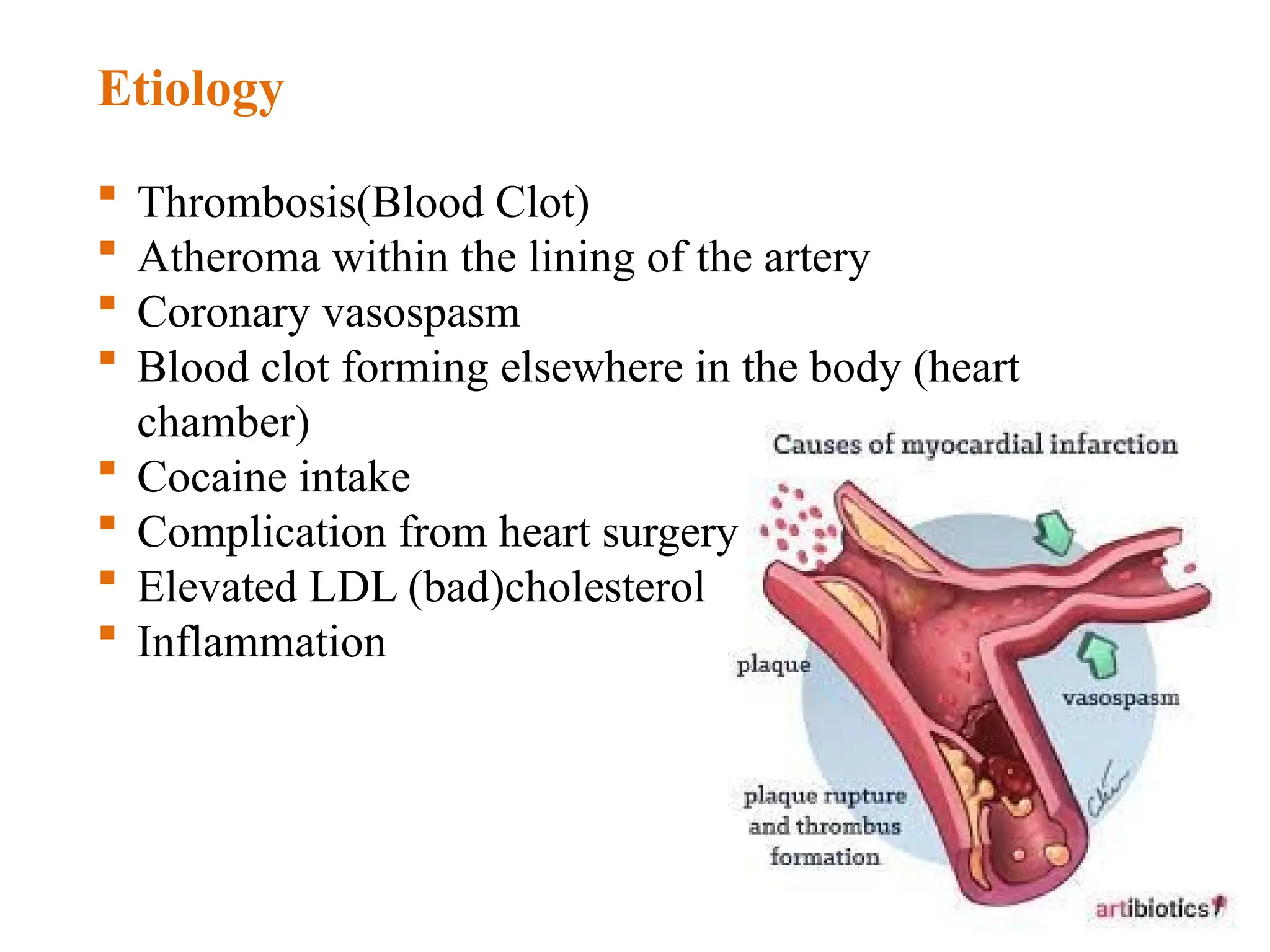 Myocardial Infarction ( MI ) Heart Attack.pptx