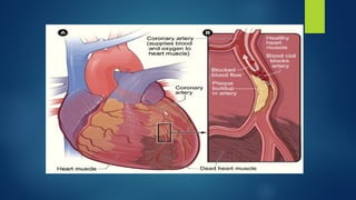 Myocardial Infarction SIGN AND SYMPTOMS TREATMENT.pptx