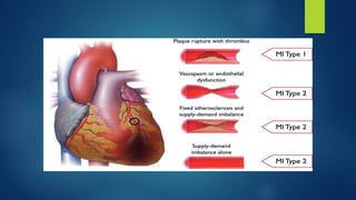 Myocardial Infarction SIGN AND SYMPTOMS TREATMENT.pptx