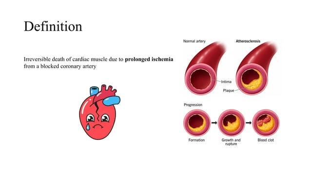 Myocardial Infarction; Pathophysiology & Management.pptx