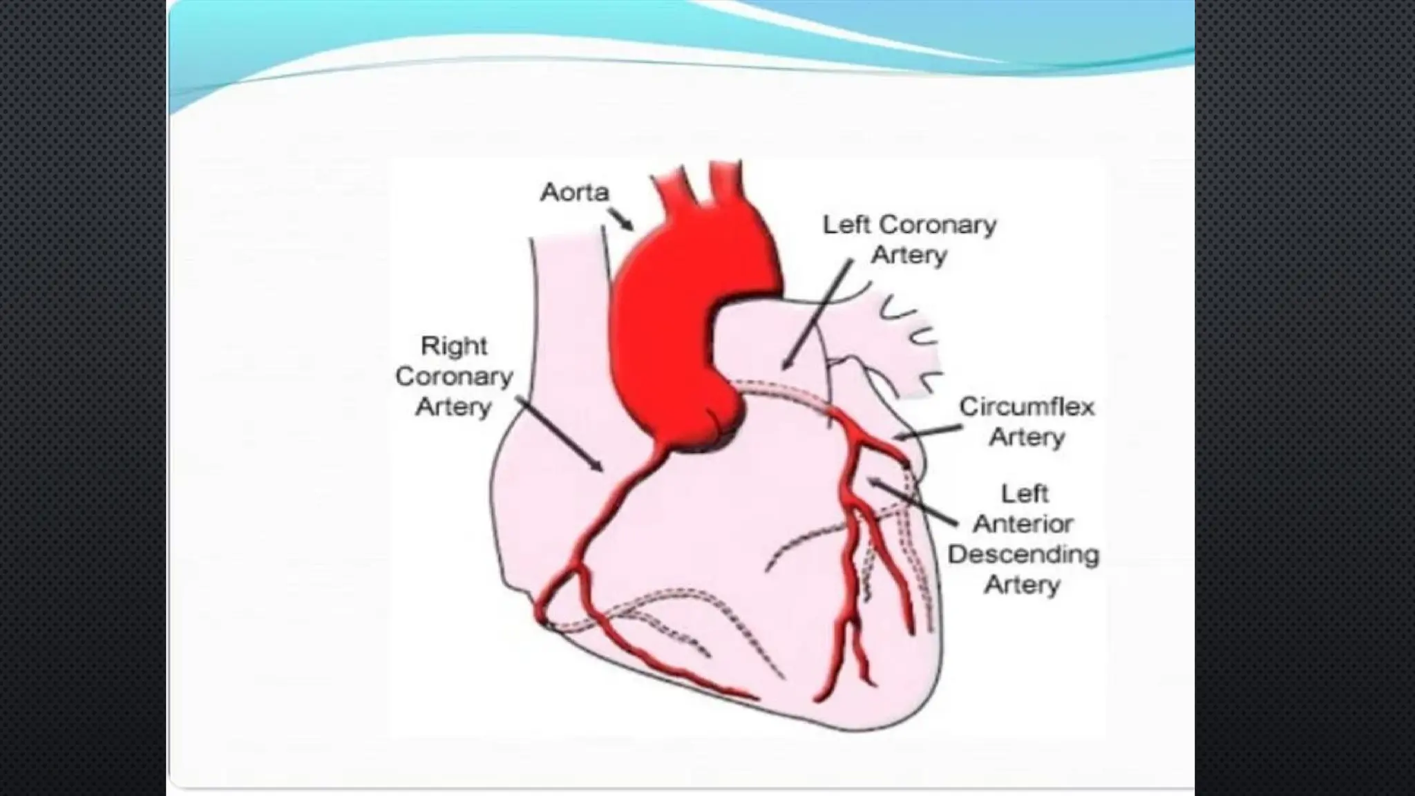 Myocardial Infarction.pptx physiology... | PPTX