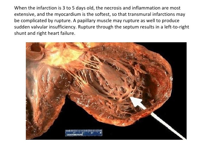 Myocardial infarction