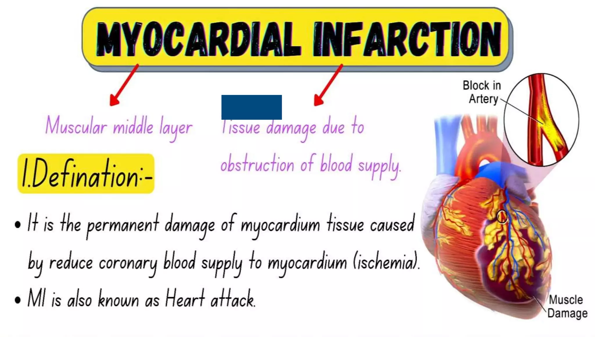 MYOCARDIAL INFARCTION SLIDESHARE | PPTX