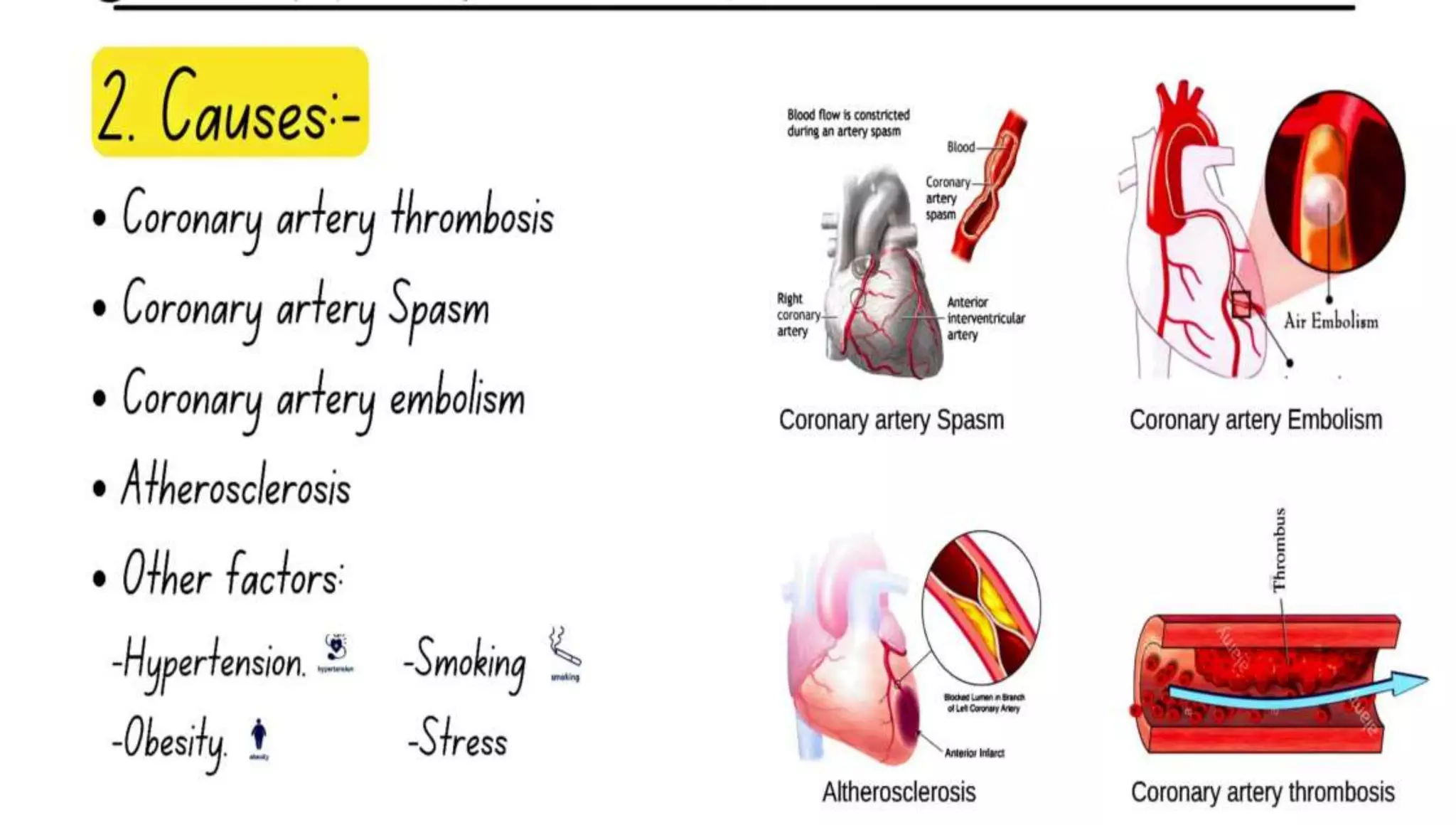 MYOCARDIAL INFARCTION SLIDESHARE | PPTX