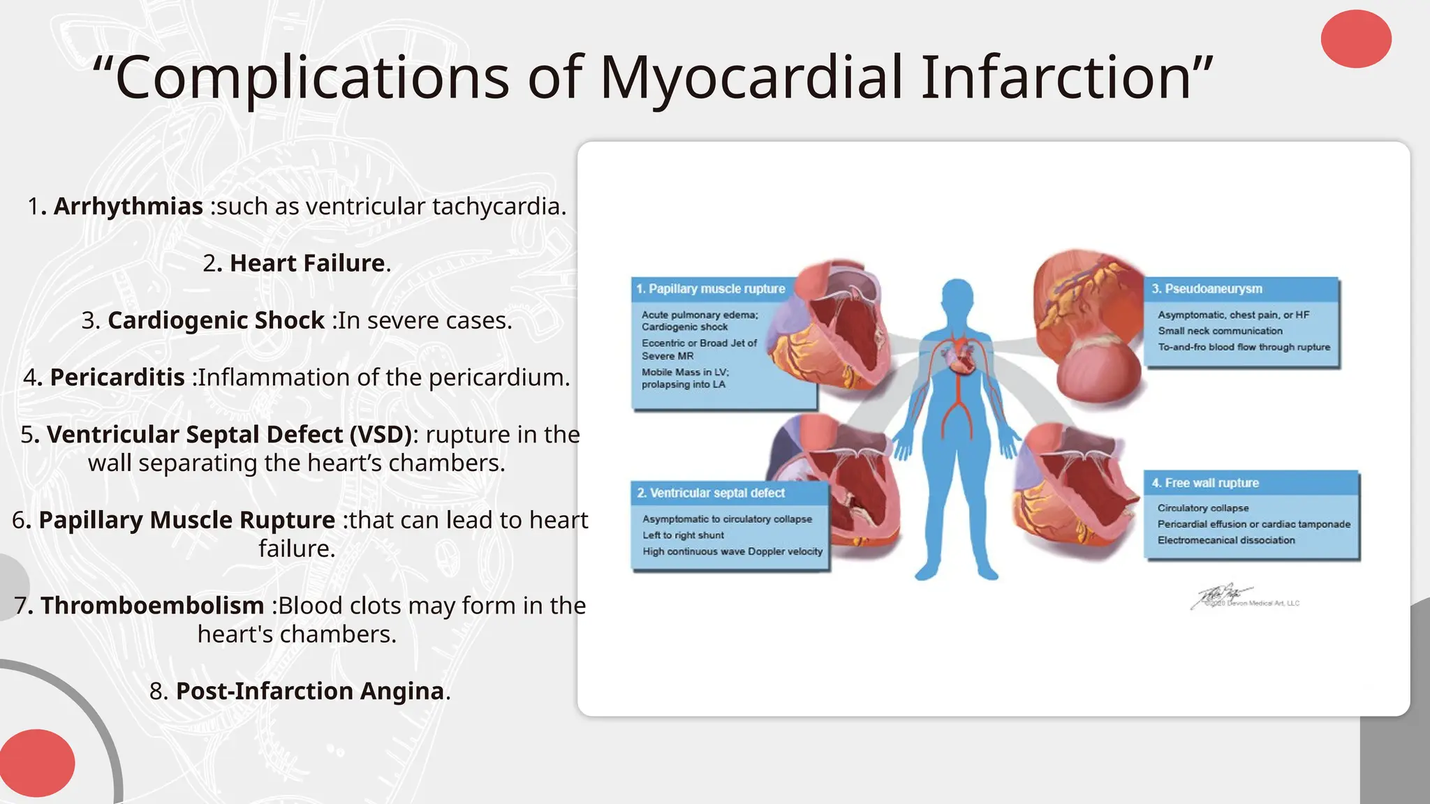 Myocardial Infarction for fist grade medical students made by iraqi ...