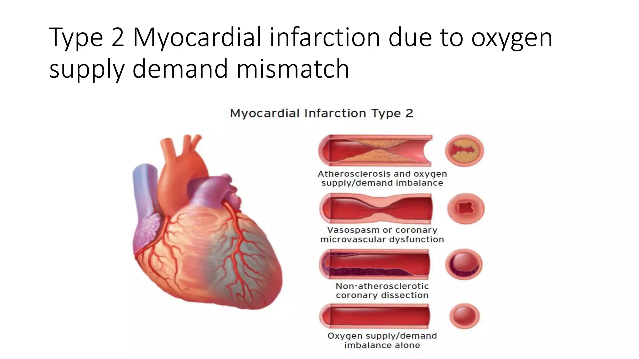 Myocardial infarction [autosaved] | PPT