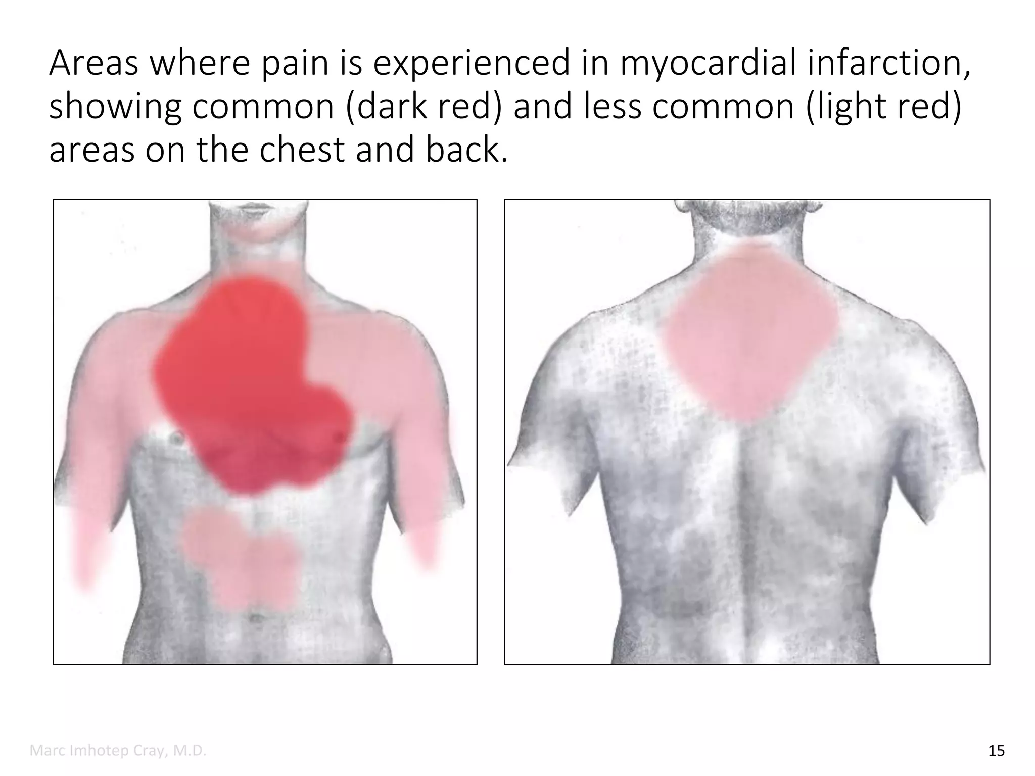 Myocardial infarction_ Causes, Symptoms, Diagnosis, Treatment, and ...