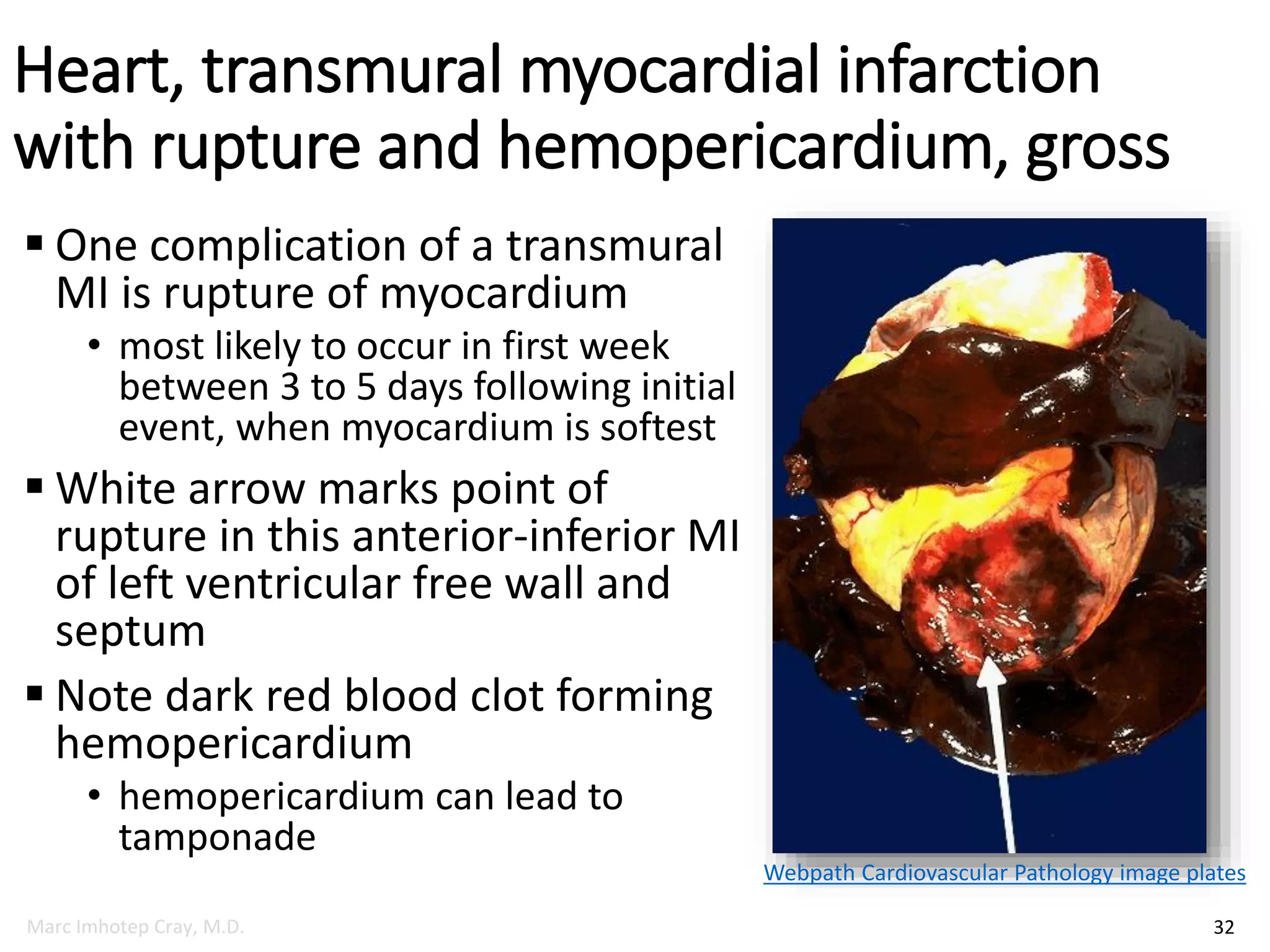 Myocardial infarction_ Causes, Symptoms, Diagnosis, Treatment, and ...