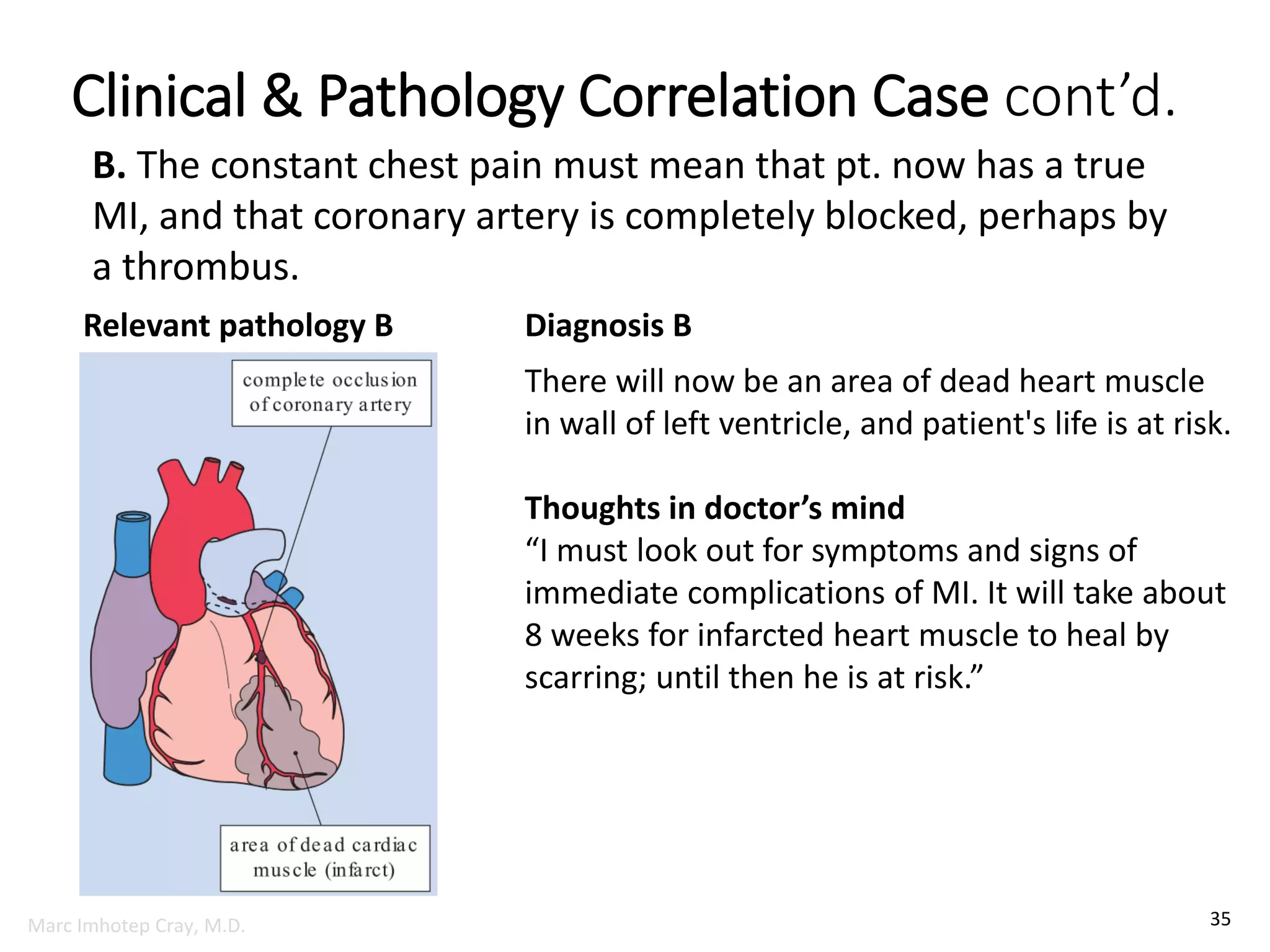 Myocardial infarction_ Causes, Symptoms, Diagnosis, Treatment, and ...