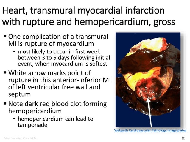 Myocardial Infarction Causes Symptoms Diagnosis Treatment And