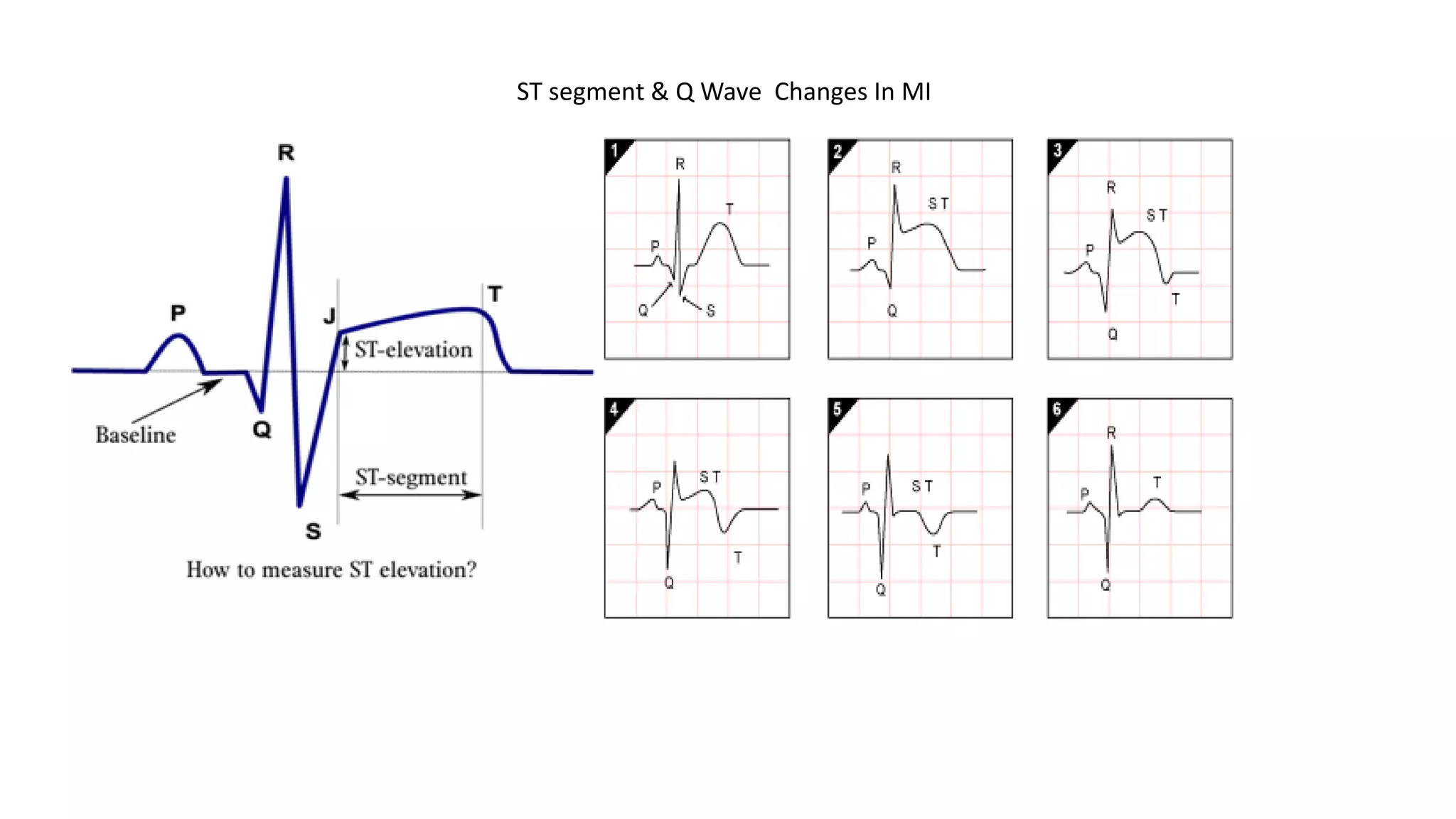 Myocardial Infarction MI [Autosaved].pptx