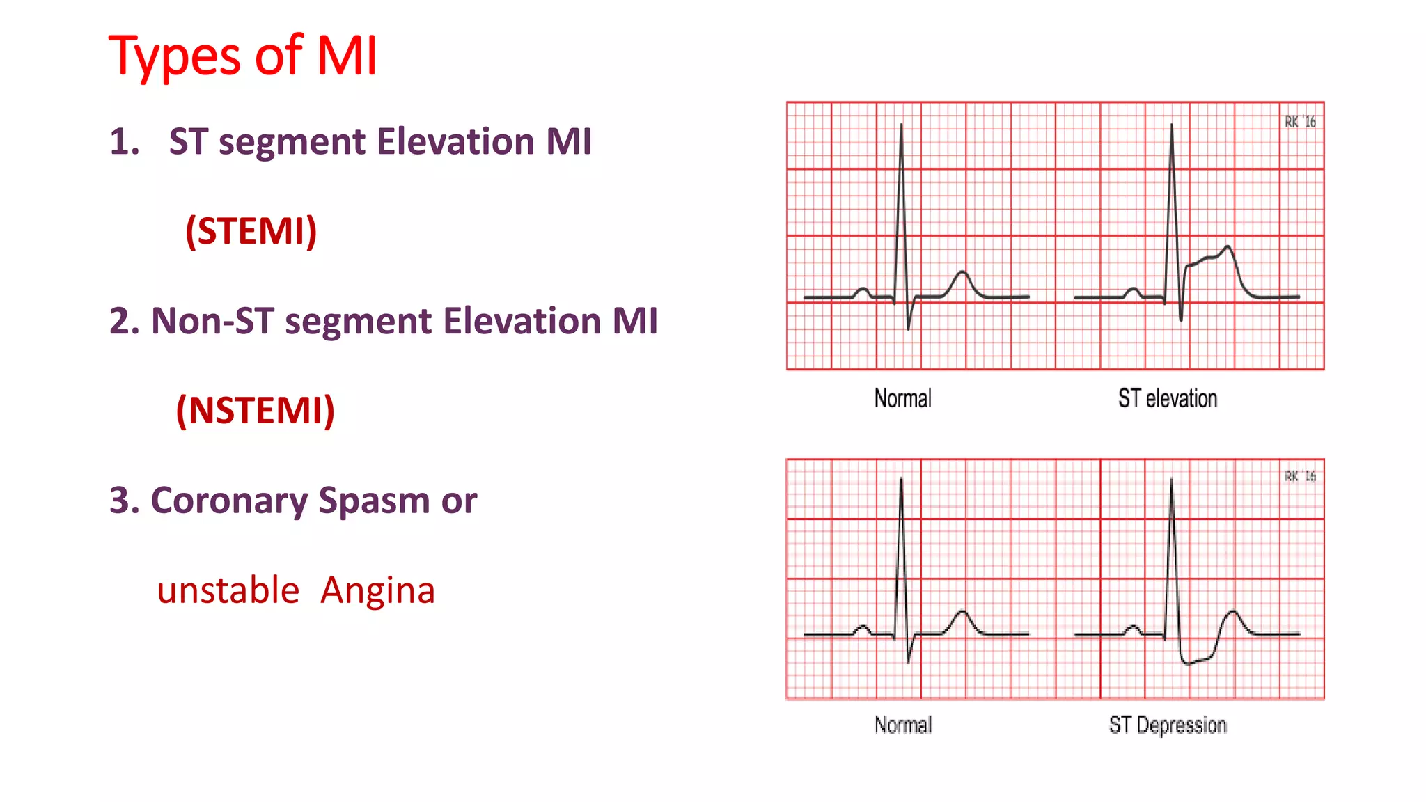 Myocardial Infarction MI [Autosaved].pptx