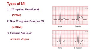 Myocardial Infarction MI [Autosaved].pptx