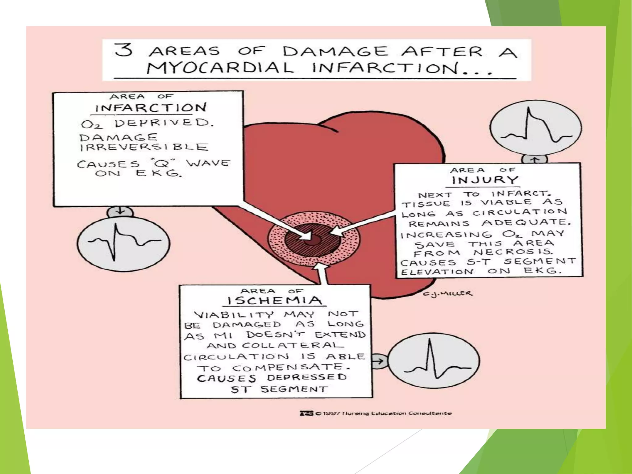 Myocardial Infarction | PPT