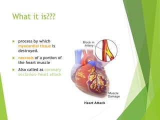 Myocardial Infarction | PPTX