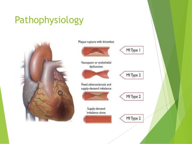 Myocardial Infarction