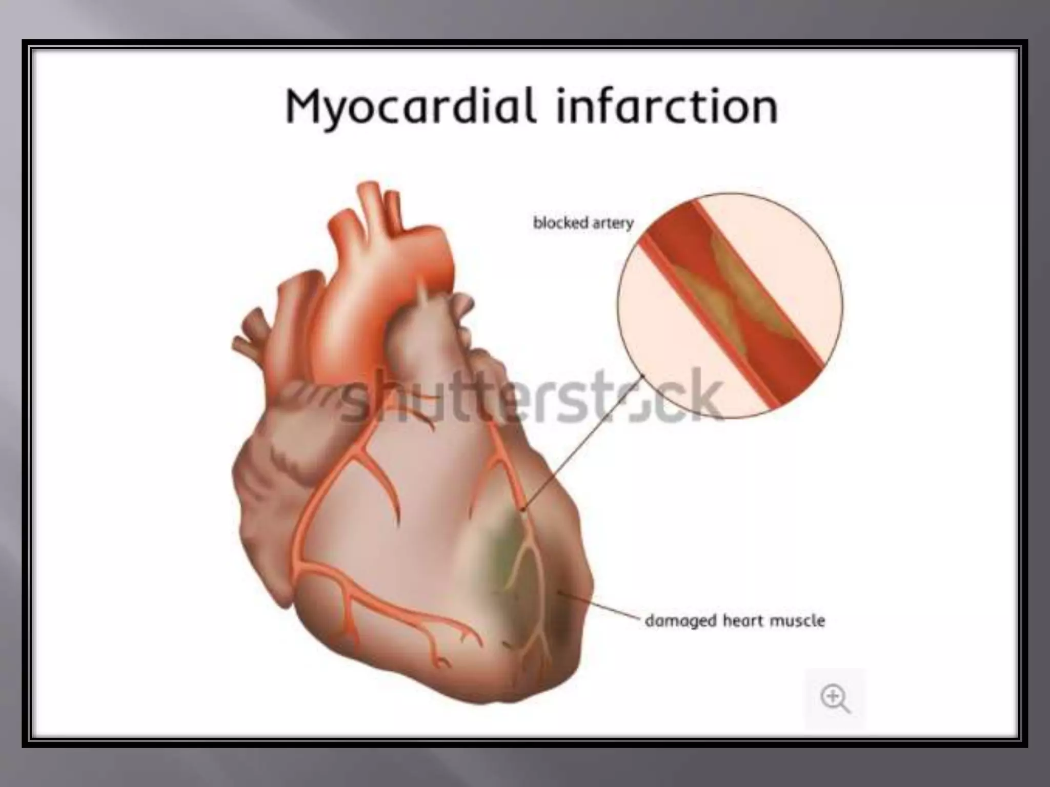Myocardial infraction | PPT
