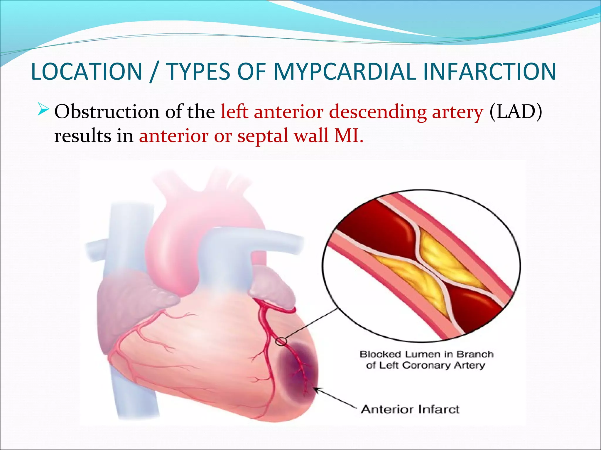 Myocardial infarction | PPT | Heart and Cardiovascular Diseases ...