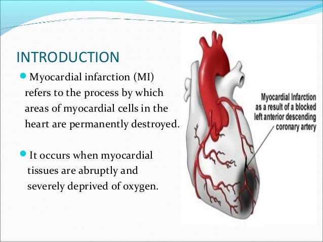 Myocardial infarction