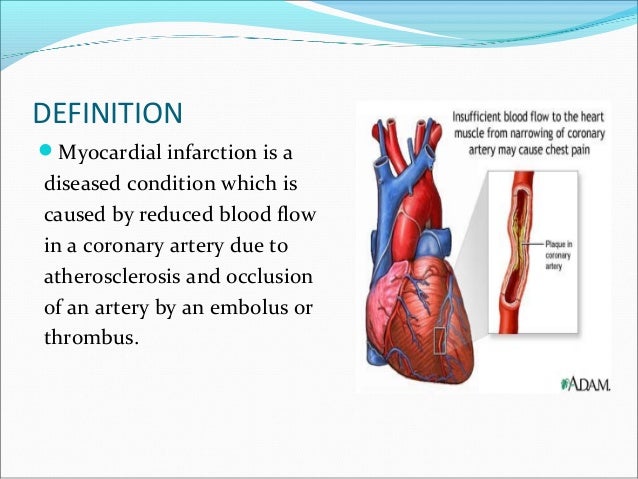Myocardial infarction